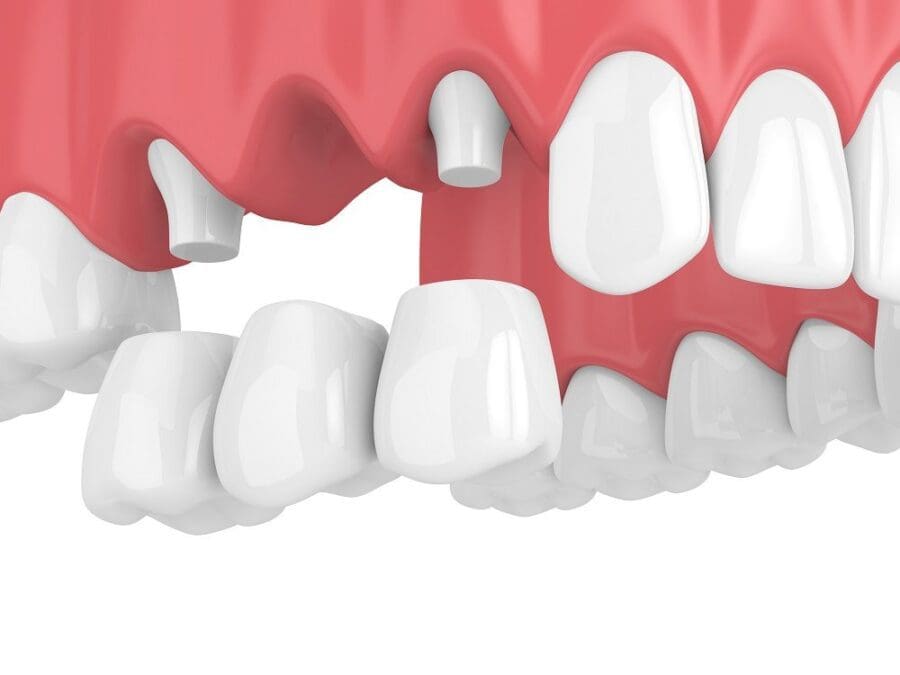 Dental Bridge Treatment in Lyndhurst, NJ